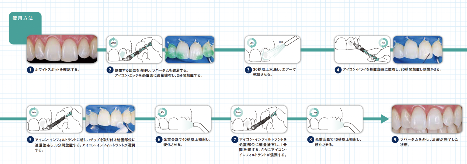 ホワイトスポット治療 アイコン（icon） 柳沢歯科クリニック